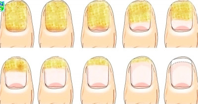 How To Get Rid Of Toenail Fungus Naturally - DIY Joy