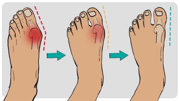 How to Fix Bunions in 5 Steps - DIY Joy